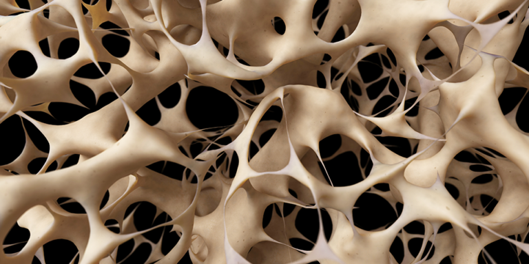 Mikä on osteoporoosi ja mistä se johtuu? - National Osteoporosis ...